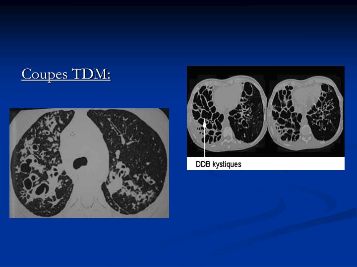 Ppt Dilatation Des Bronches Powerpoint Presentation Id 6027917
