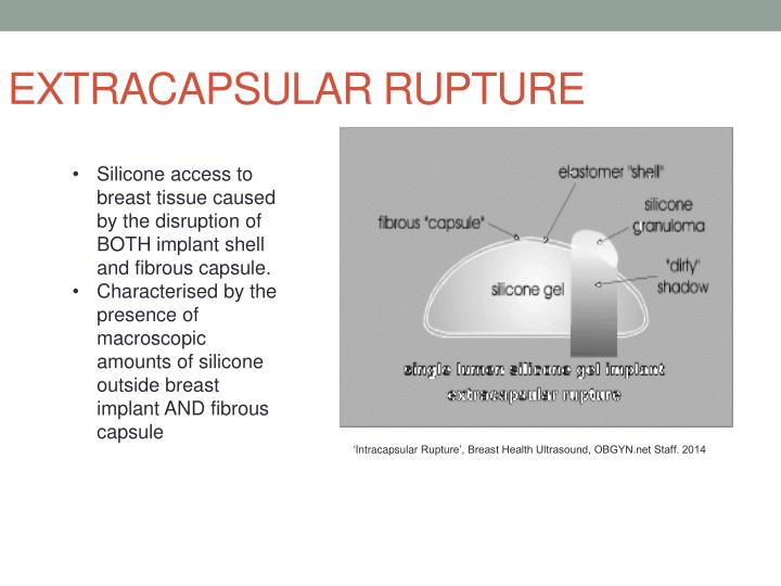 Ppt Breast Implant Rupture Powerpoint Presentation Id 6071273