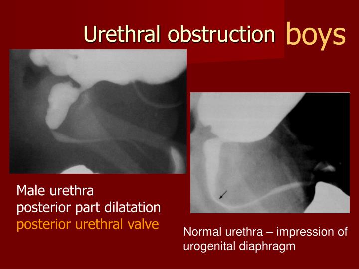 PPT - Urinary tract imaging diagnostic in children PowerPoint ...