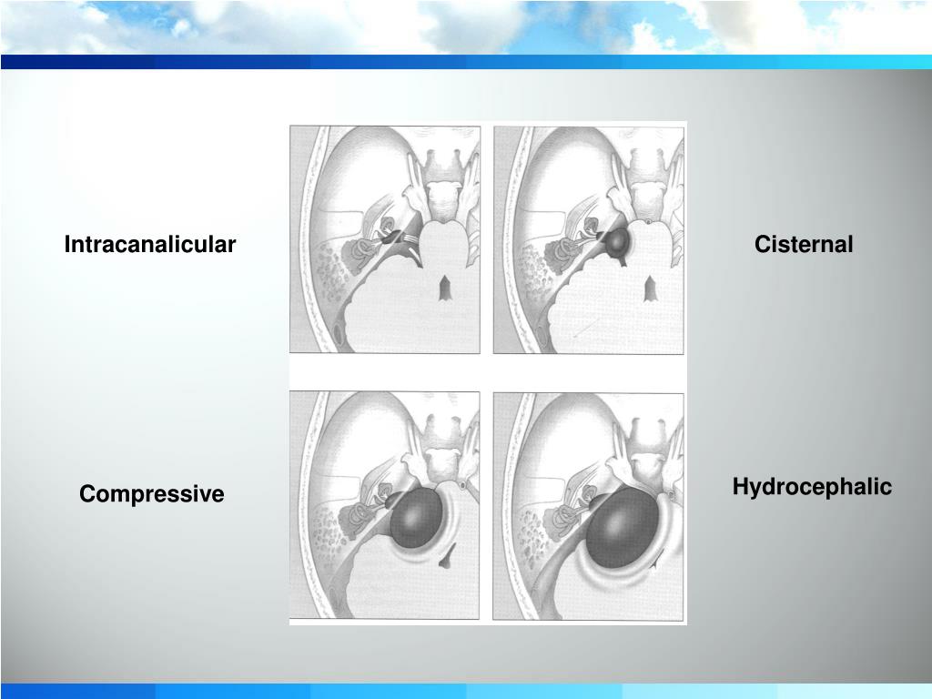 PPT - Acoustic Neuroma Department of Otorhinolaryngoglogy PowerPoint ...
