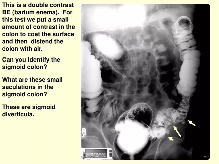 PPT - Can you identify the sigmoid colon? PowerPoint Presentation, free ...