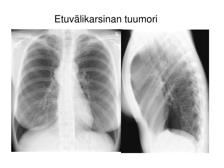 PPT - Thorax-rtg, RO6¤ PowerPoint Presentation - ID:5386644