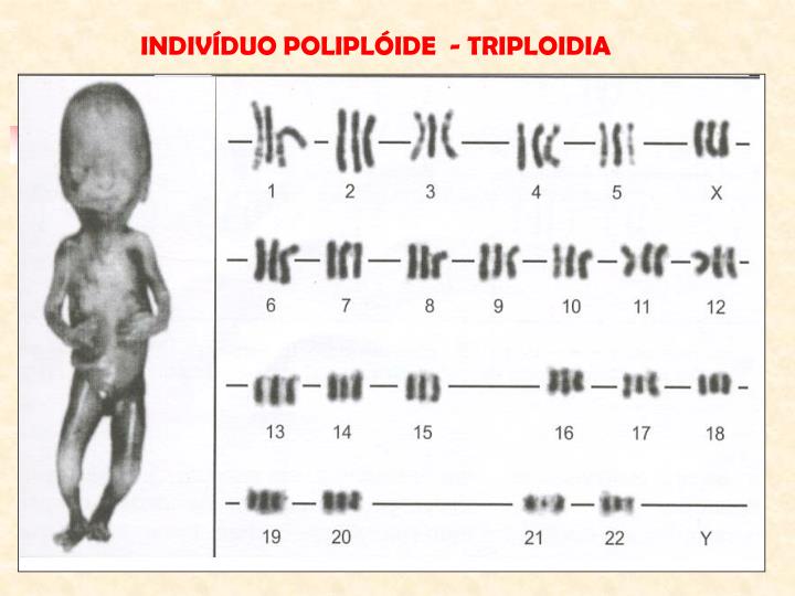 PPT - Síndromes genéticas PowerPoint Presentation - ID:5386835