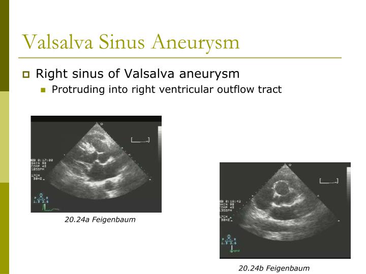 PPT - Diseases of the Great Vessels PowerPoint Presentation - ID:5387383