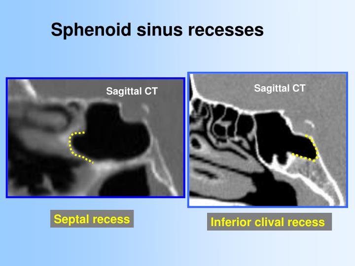 PPT - Anatomy and relevant anatomical variants in nasal and paranasal ...