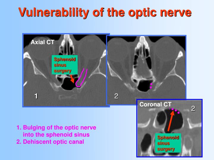 PPT - Anatomy and relevant anatomical variants in nasal and paranasal ...