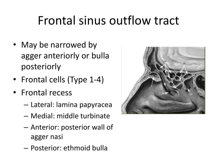 PPT - Radiology of Nasal Cavity and Paranasal Sinuses PowerPoint ...