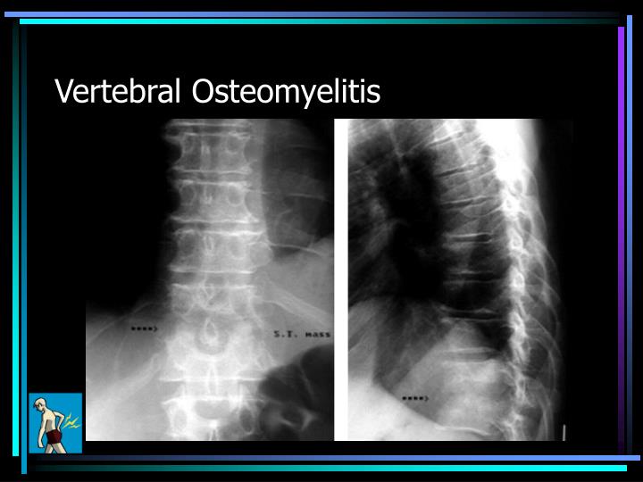 PPT - Back Pain PowerPoint Presentation - ID:5410160