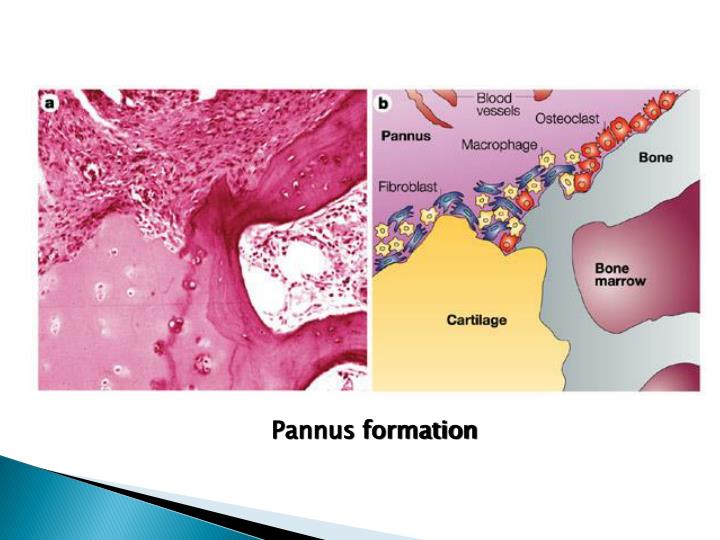 PPT - Joints Pathology PowerPoint Presentation - ID:5410435
