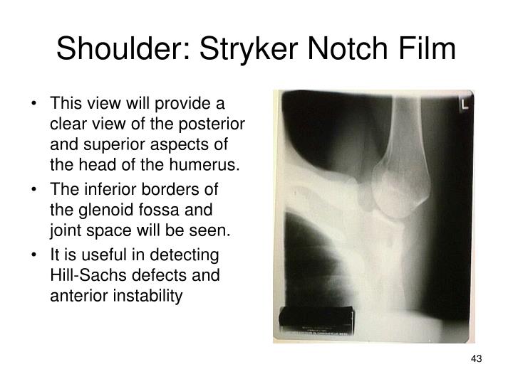 PPT - 14.1 Shoulder Radiography PowerPoint Presentation - ID:5414909