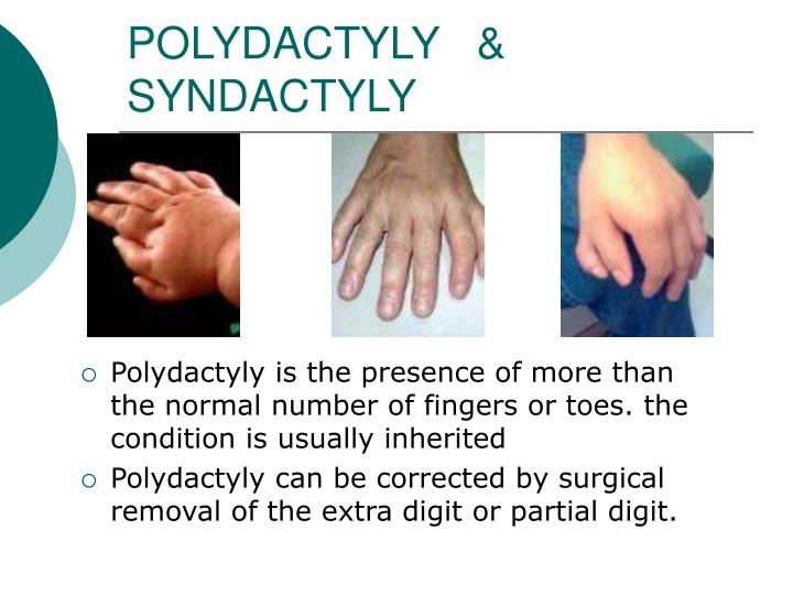 PPT - BIRTH DEFECTS PowerPoint Presentation - ID:5425969