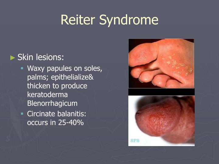 PPT - Diseases of Joints and Spine PowerPoint Presentation - ID:5426282