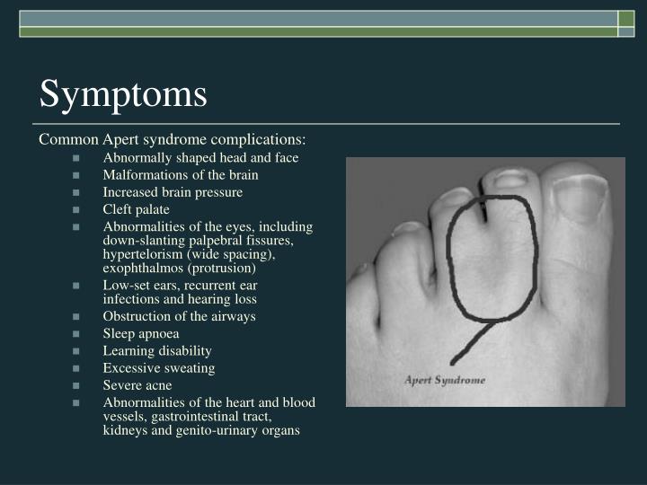 PPT - Apert Syndrome PowerPoint Presentation - ID:5429450