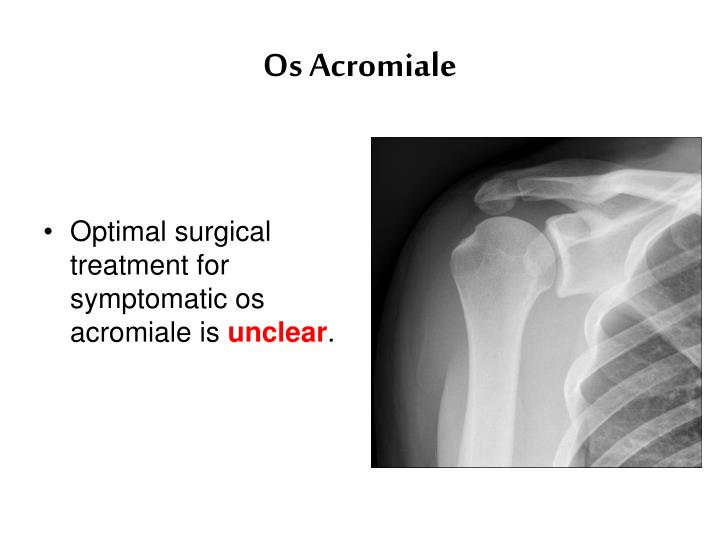 PPT - Impingement Syndrome PowerPoint Presentation - ID:5436216