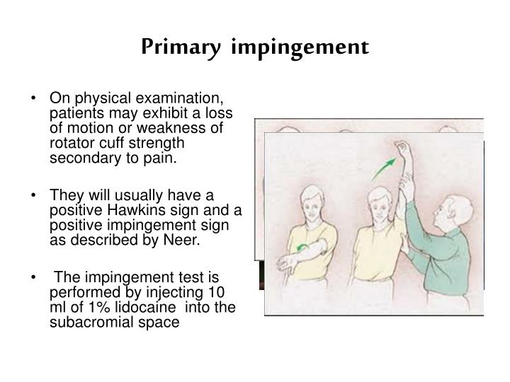 PPT - Impingement Syndrome PowerPoint Presentation - ID:5436216