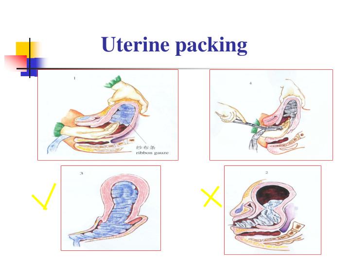 PPT - Post Partum Hemorrhage Uterine Rupture PowerPoint Presentation ...