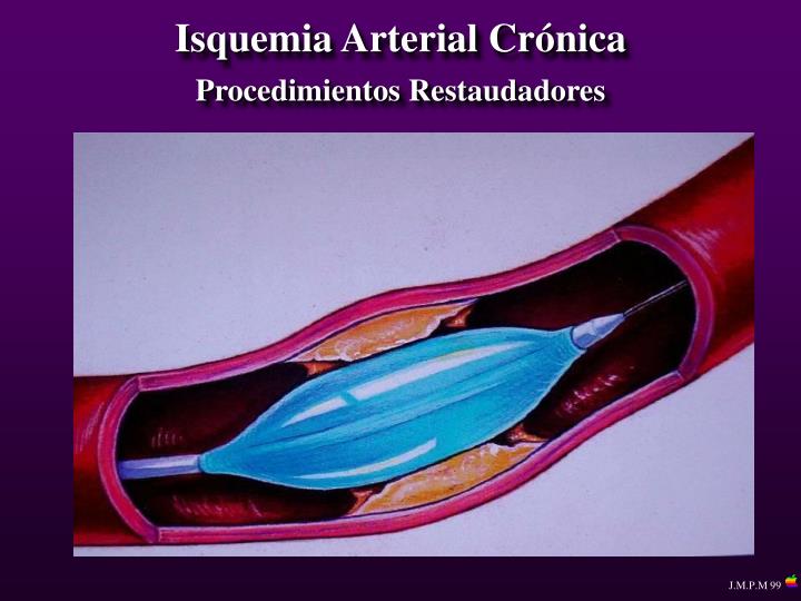 PPT - Isquemia Arterial Crónica PowerPoint Presentation - ID:5440568
