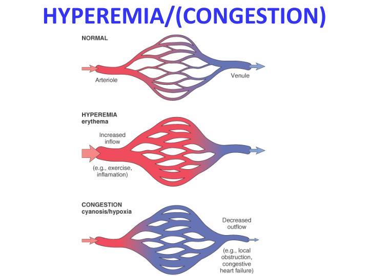 PPT - Hemodynamic Disorders PowerPoint Presentation - ID:5441330