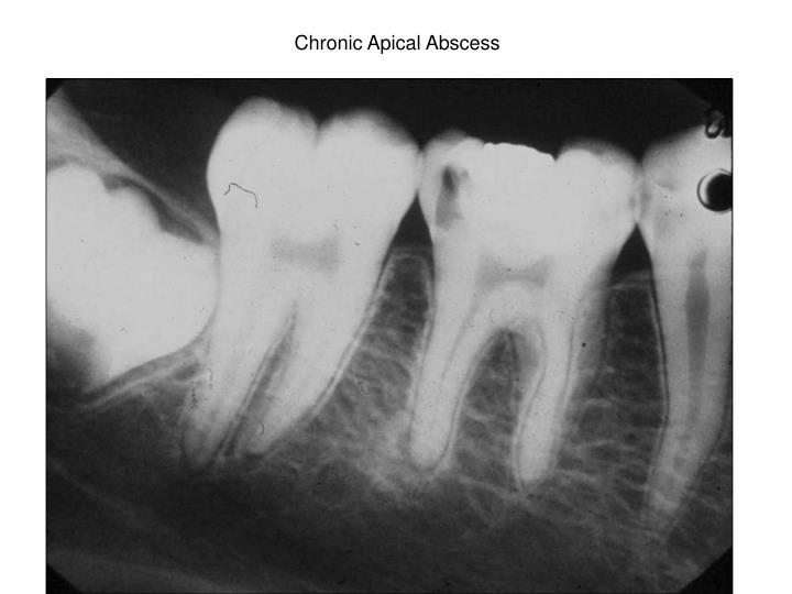 PPT - RADIOGRAPHIC INTERPRETATION OF PULPAL AND PERIAPICAL DISEASE ...