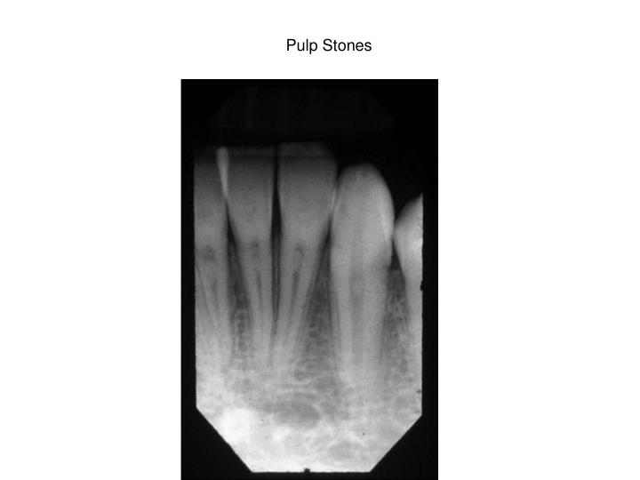 PPT - RADIOGRAPHIC INTERPRETATION OF PULPAL AND PERIAPICAL DISEASE ...