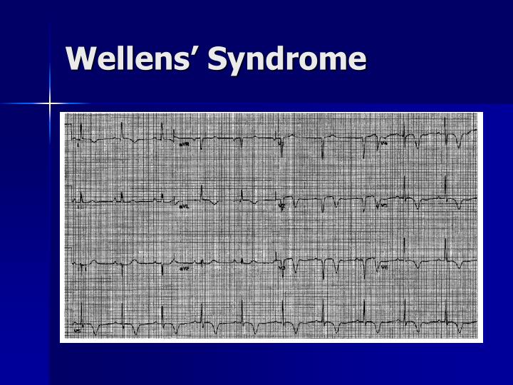 PPT - Acute Coronary Syndromes PowerPoint Presentation - ID:5459218