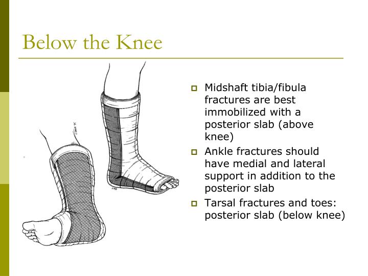 PPT - Splinting Seminar PowerPoint Presentation - ID:5465564