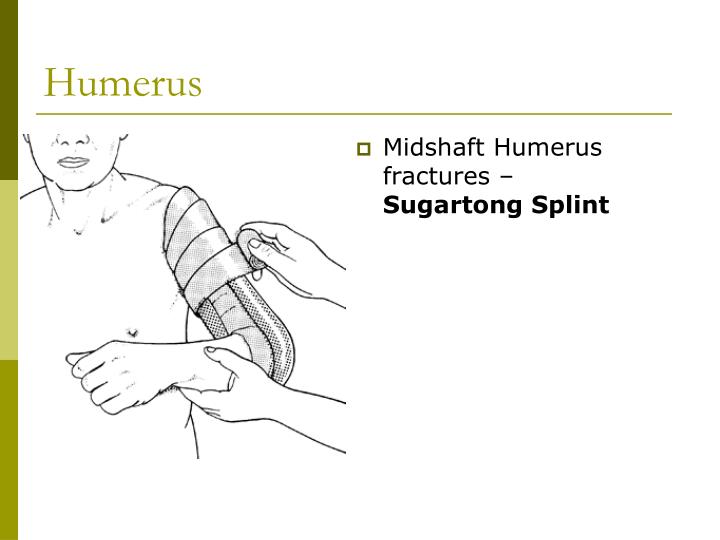 PPT - Splinting Seminar PowerPoint Presentation - ID:5465564