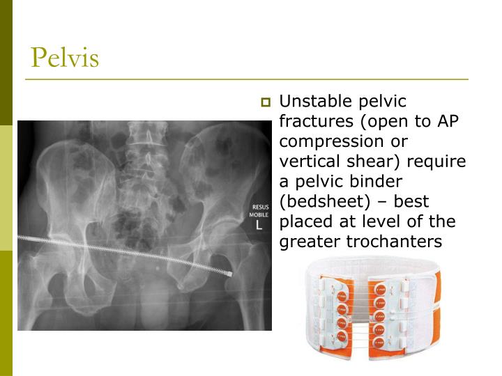 PPT - Splinting Seminar PowerPoint Presentation - ID:5465564