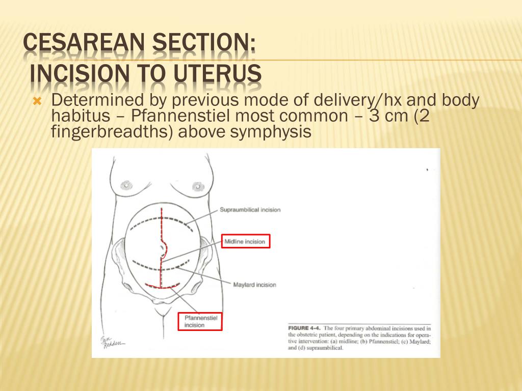 Ppt Cesarean Section Powerpoint Presentation Free Download Id 5481243