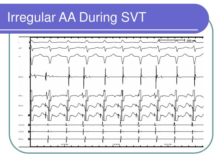 PPT - Differential Diagnoses Of SVT: Common EP Lab Techniques ...