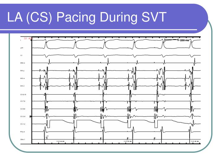 PPT - Differential Diagnoses Of SVT: Common EP Lab Techniques ...