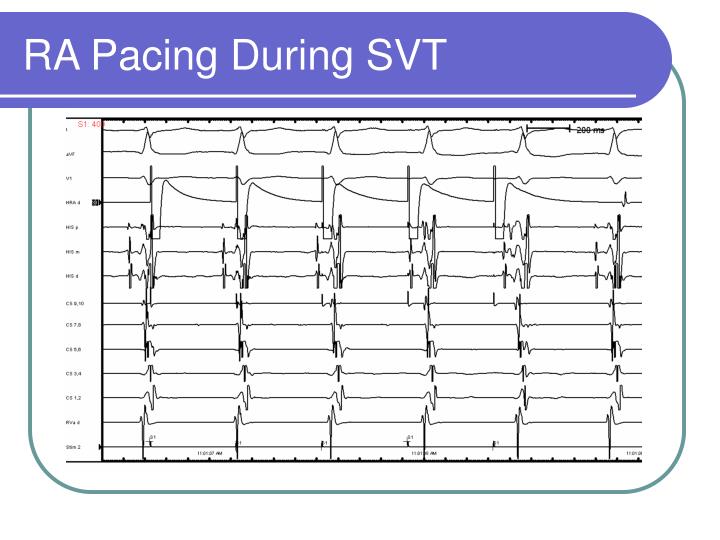 PPT - Differential Diagnoses Of SVT: Common EP Lab Techniques ...