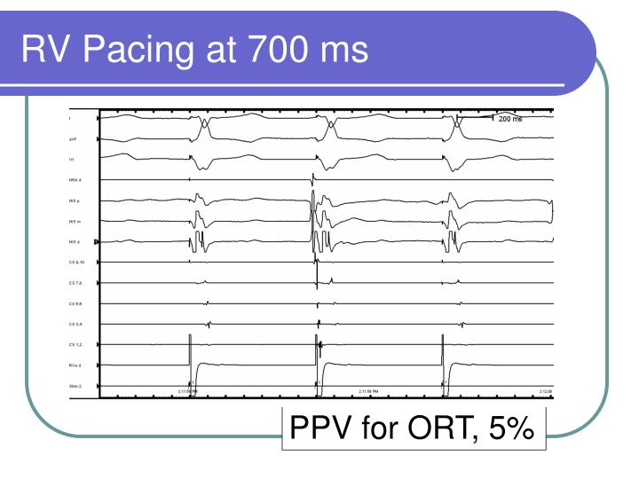 PPT - Differential Diagnoses Of SVT: Common EP Lab Techniques ...