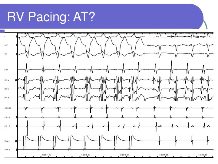 PPT - Differential Diagnoses Of SVT: Common EP Lab Techniques ...