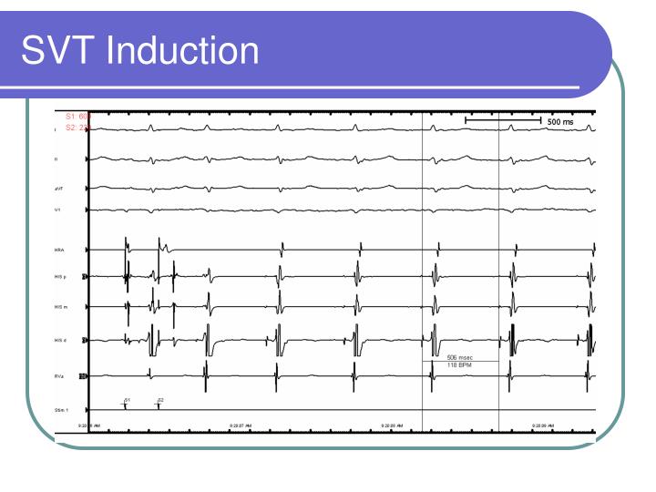 PPT - Differential Diagnoses Of SVT: Common EP Lab Techniques ...