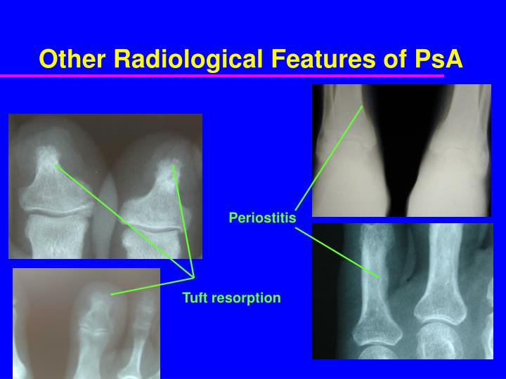 PPT - Psoriatic Arthritis Clinical Features and Epidemiology PowerPoint ...