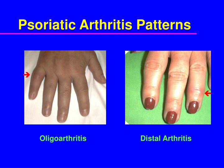 PPT - Psoriatic Arthritis Clinical Features and Epidemiology PowerPoint ...
