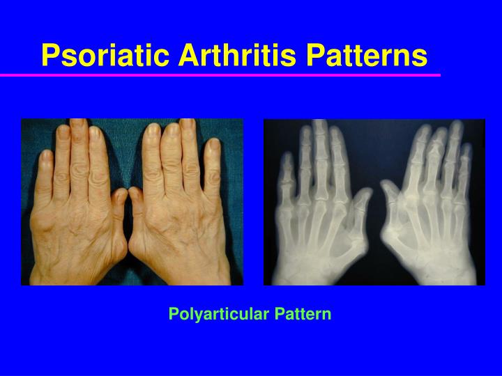 PPT - Psoriatic Arthritis Clinical Features and Epidemiology PowerPoint ...