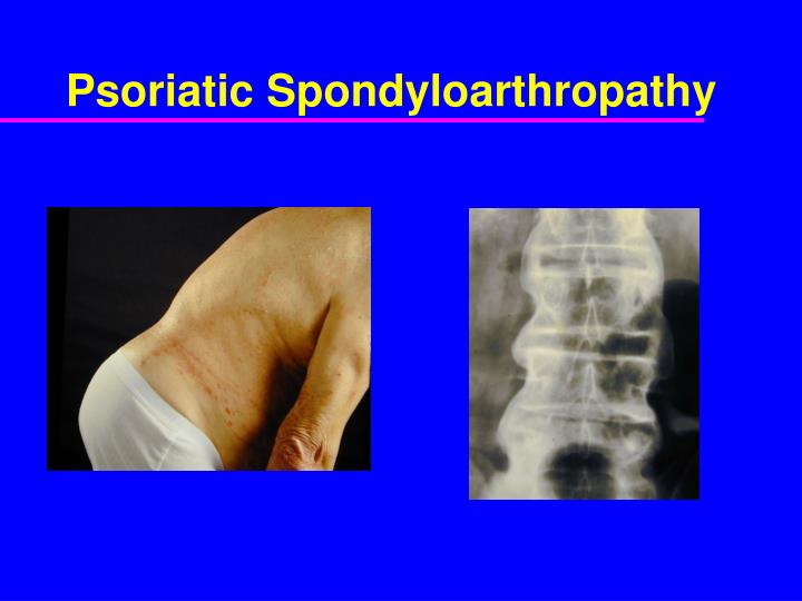PPT - Psoriatic Arthritis Clinical Features and Epidemiology PowerPoint ...