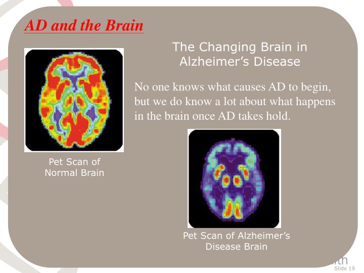 PPT - Different faces of Dementia PowerPoint Presentation - ID:5490306