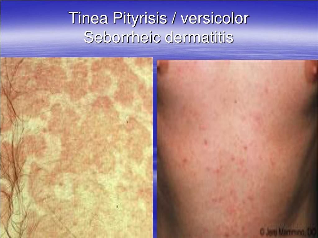 Ppt Bacterial And Fungal Skin Soft Tissue And Muscle Infections