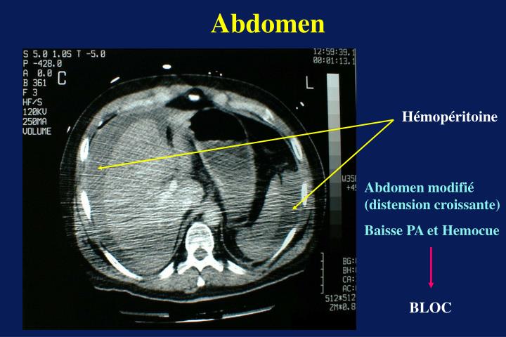 PPT - Prise en charge du patient Polytraumatisé PowerPoint Presentation ...