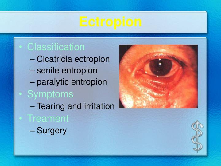 PPT - Lids Disease PowerPoint Presentation - ID:5500339