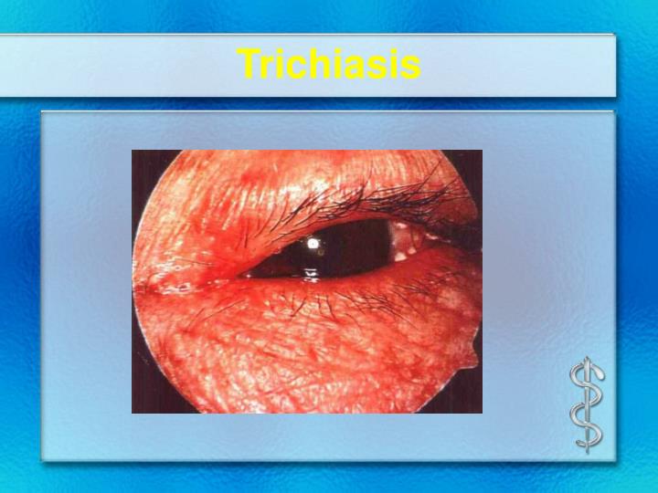 PPT - Lids Disease PowerPoint Presentation - ID:5500339
