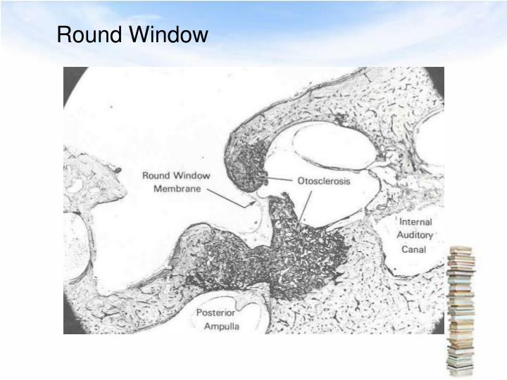 PPT - Otosclerosis PowerPoint Presentation - ID:5505894
