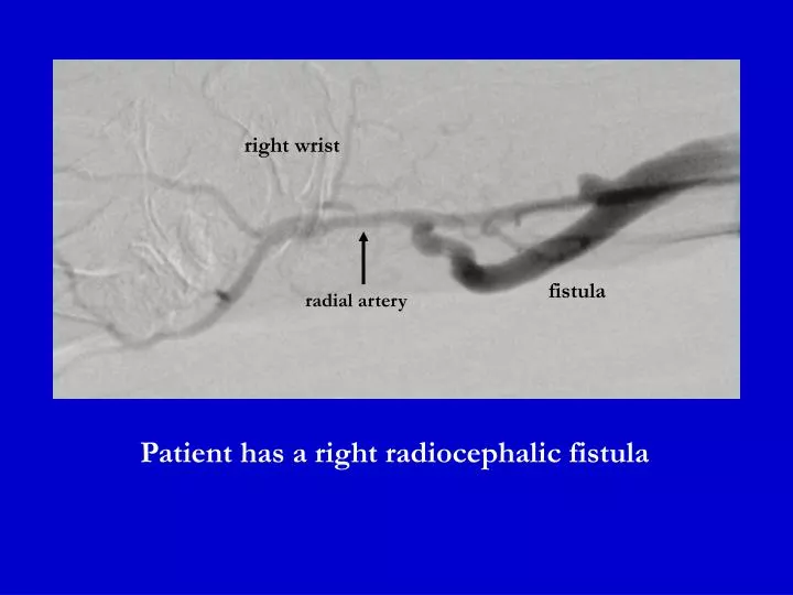 PPT - Patient has a right radiocephalic fistula PowerPoint Presentation ...