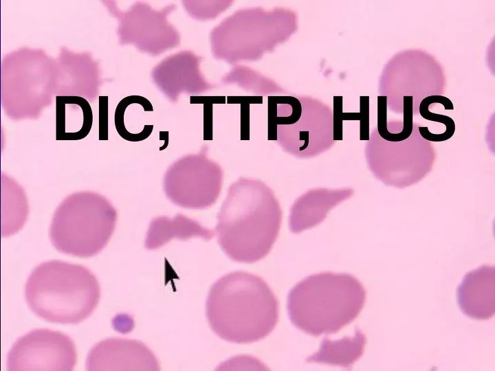 PPT - DIC, TTP, HUS PowerPoint Presentation, free download - ID:5512268