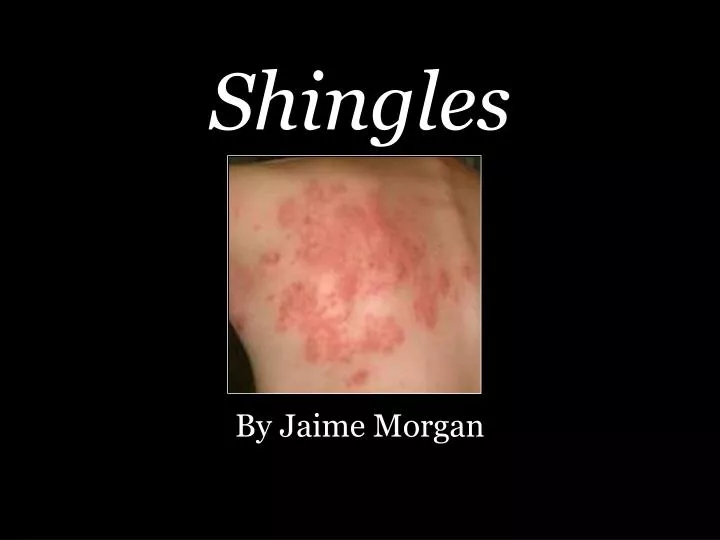 Ppt Shingles Powerpoint Presentation Free Download Id5515166