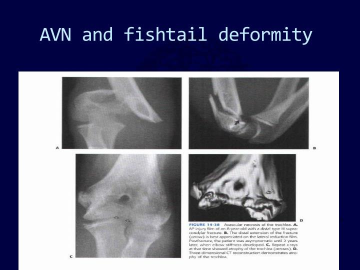 PPT - PEDIATRIC SUPRACONDYLAR HUMERUS FRACTURE PowerPoint Presentation ...