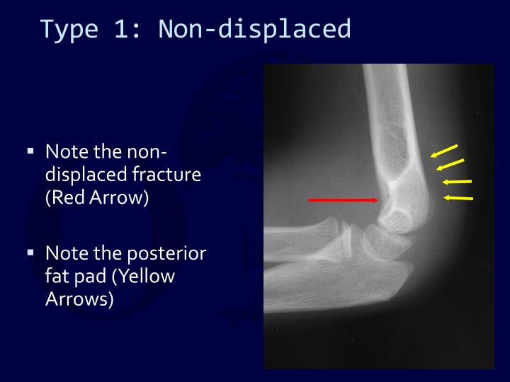 PPT - PEDIATRIC SUPRACONDYLAR HUMERUS FRACTURE PowerPoint Presentation ...